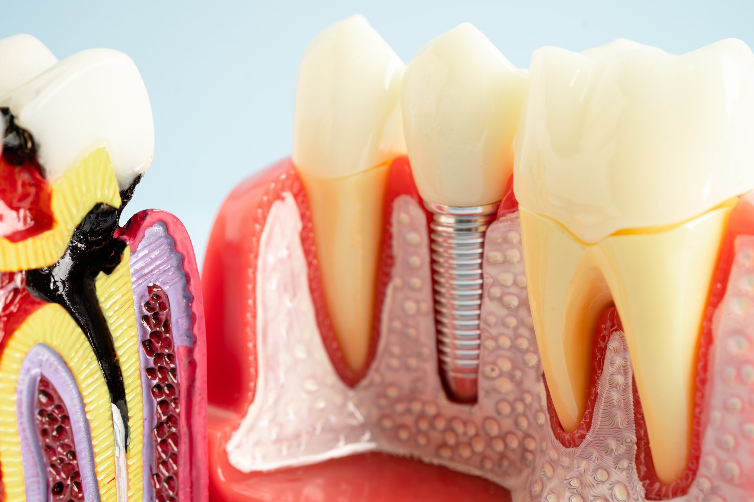 Implant Types: Which One Is Right for Your Dental Needs?